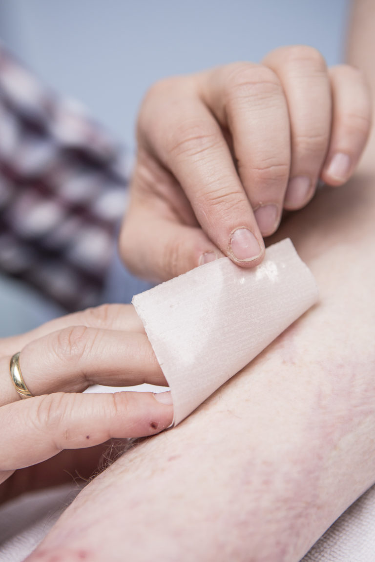 Nazorg voor patiënten met brandwonden - Oscare vzw